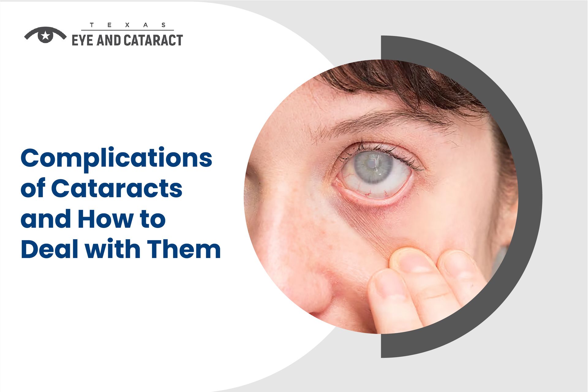 Cataract