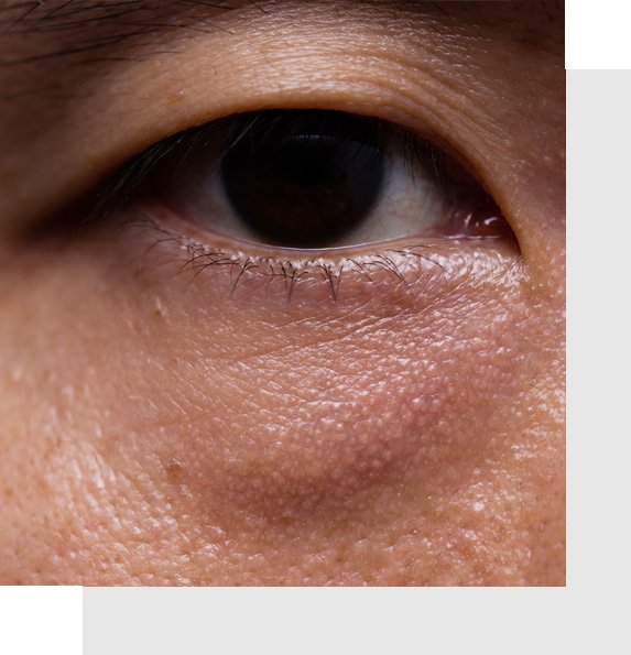Droopy Eyelids Ptosis - Texas Eye and Cataract