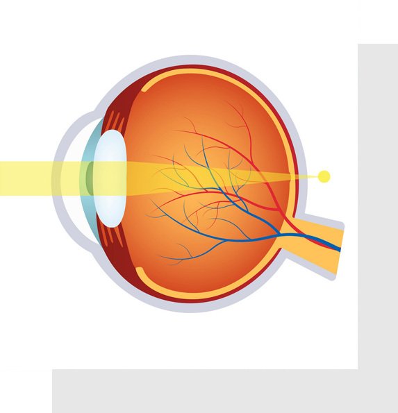 Hyperopia: Symptoms, Causes, Diagnosis & Treatment - Texas Eye and Cataract