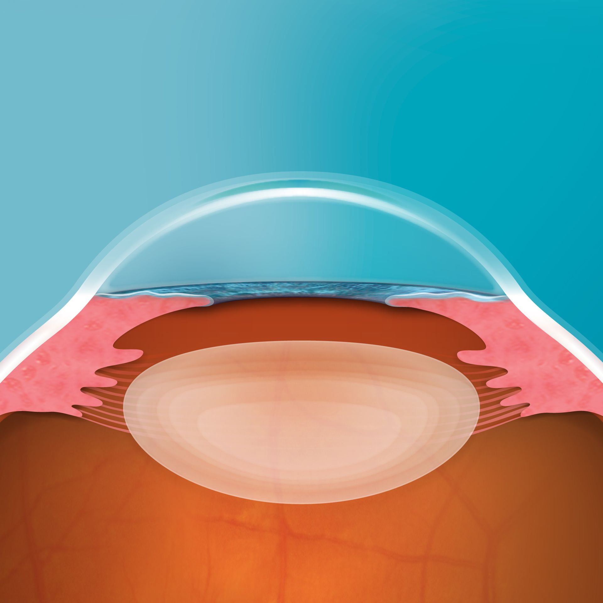 EVO ICL Surgery | Texas Eye and Cataract