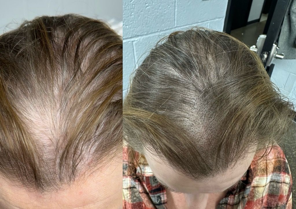 Scalp Micropigmentation Specialist; Professional Scalp | Moline, IL ...