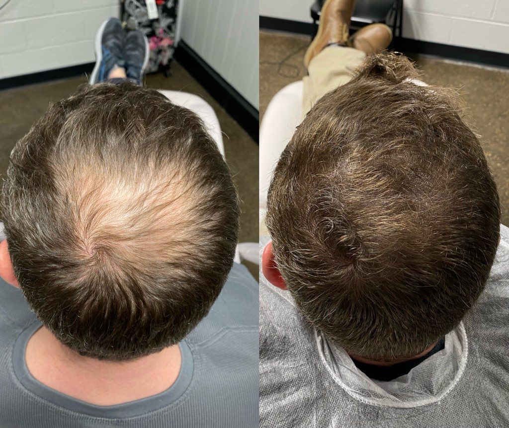 Scalp Micropigmentation Specialist; Professional Scalp | Moline, IL ...