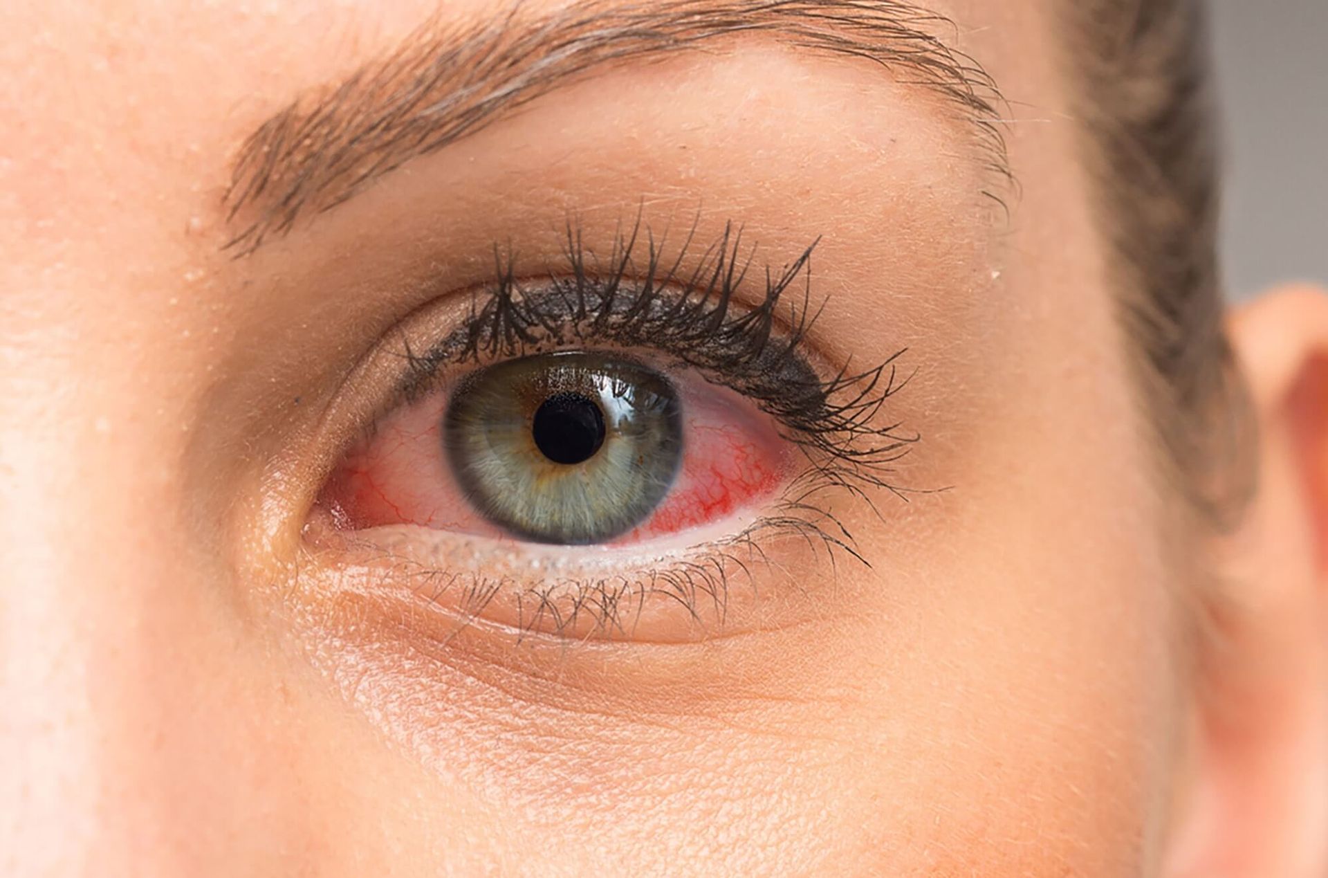 Conjunctivitis vs. Stye: Key Differences & Best Treatments