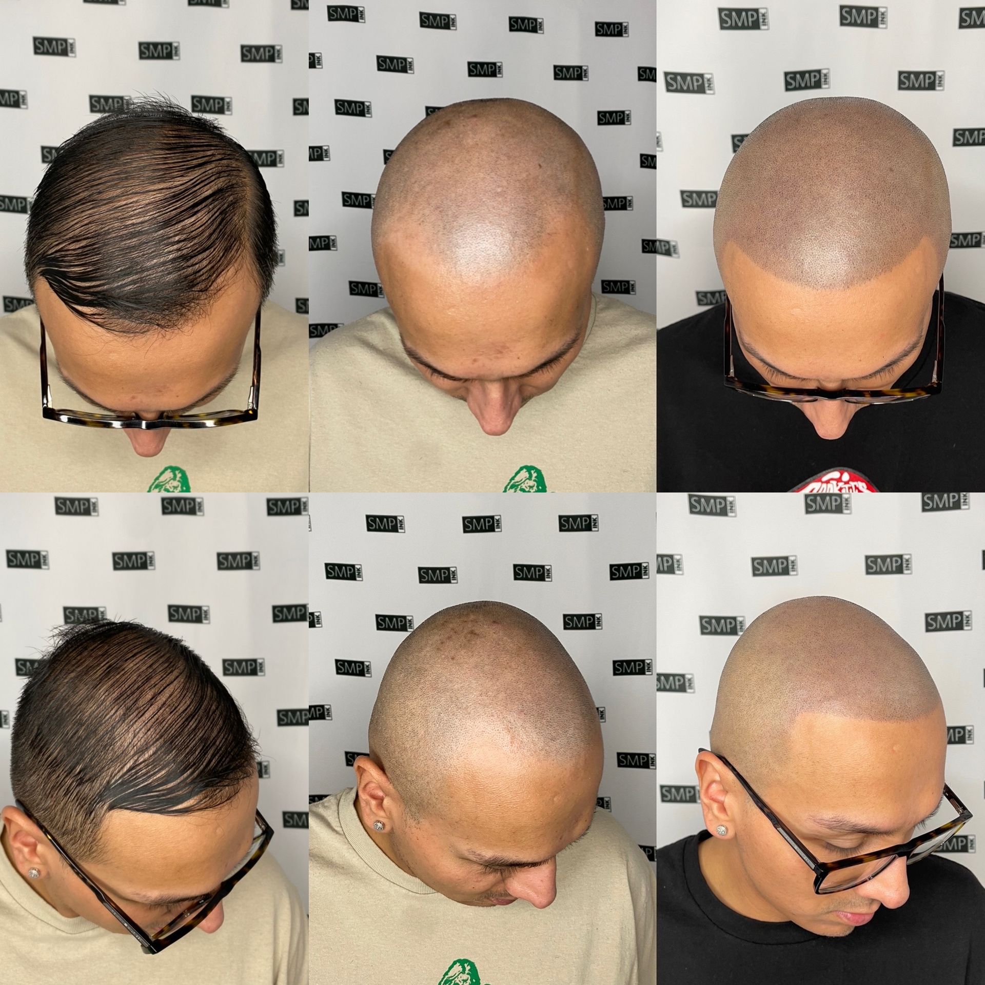 Expert SMP for Men | Restore Hair with SMP Ink CDA