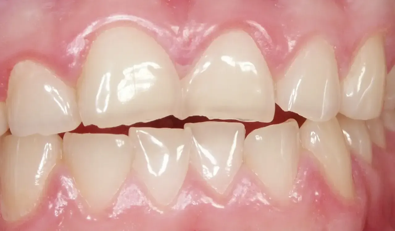 Symptomer på syreksader på tenner (2024)