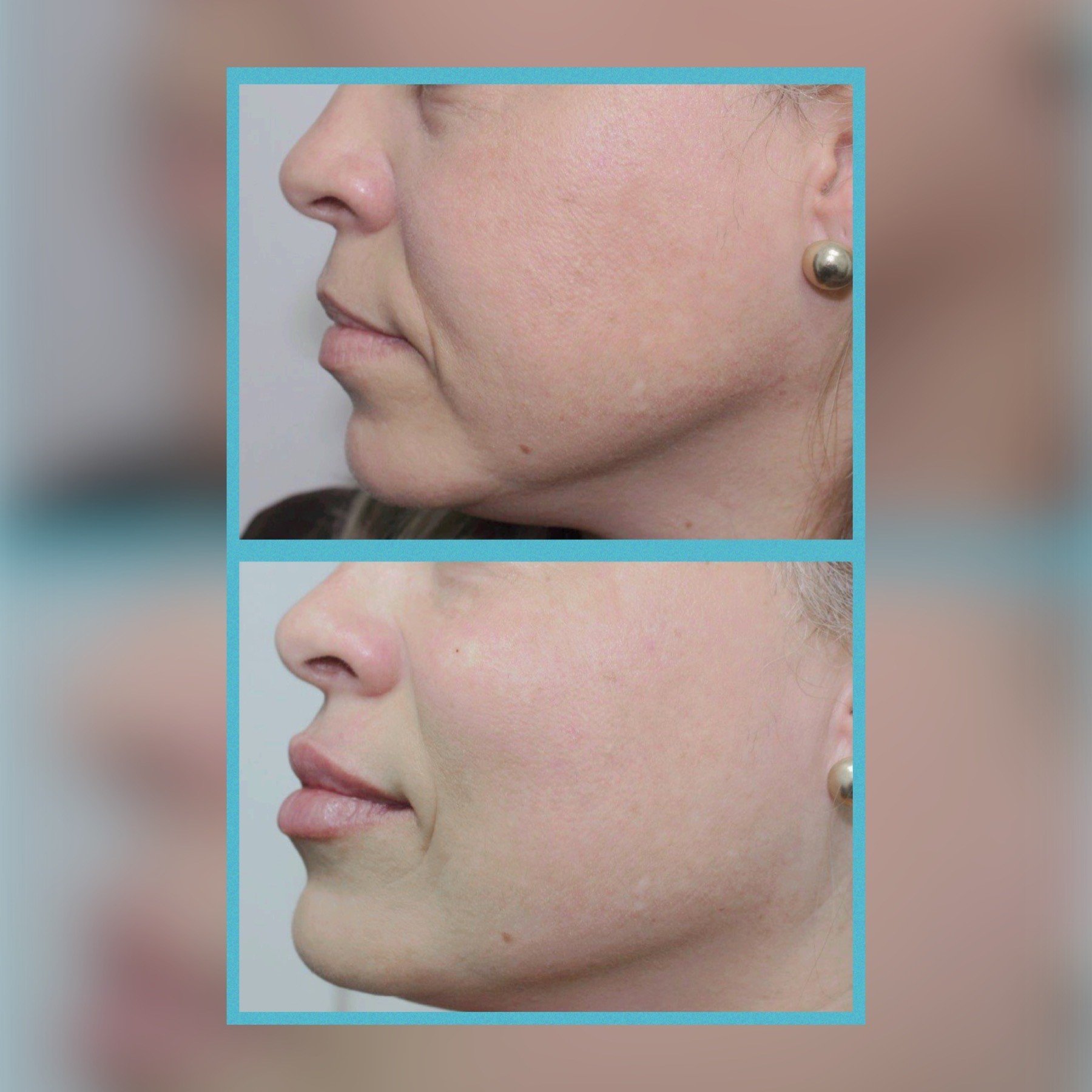 Botox® & Dermal Fillers | Facial Treatments | Houston, TX | Clinic 45