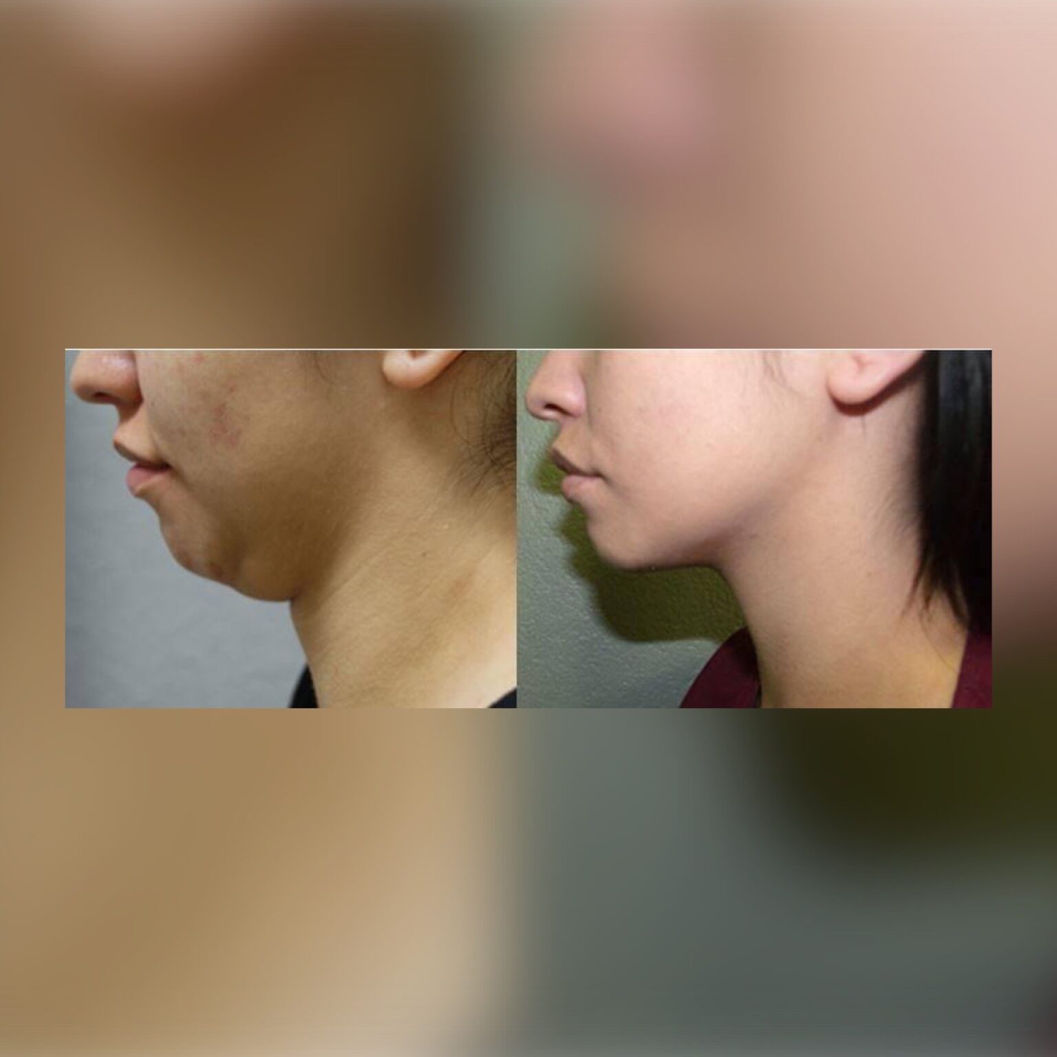 Smart Liposuction Surgery | Houston, TX | Clinic 45