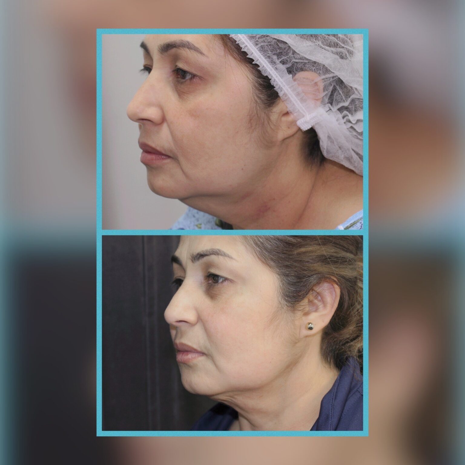 Smart Liposuction Surgery | Houston, TX | Clinic 45