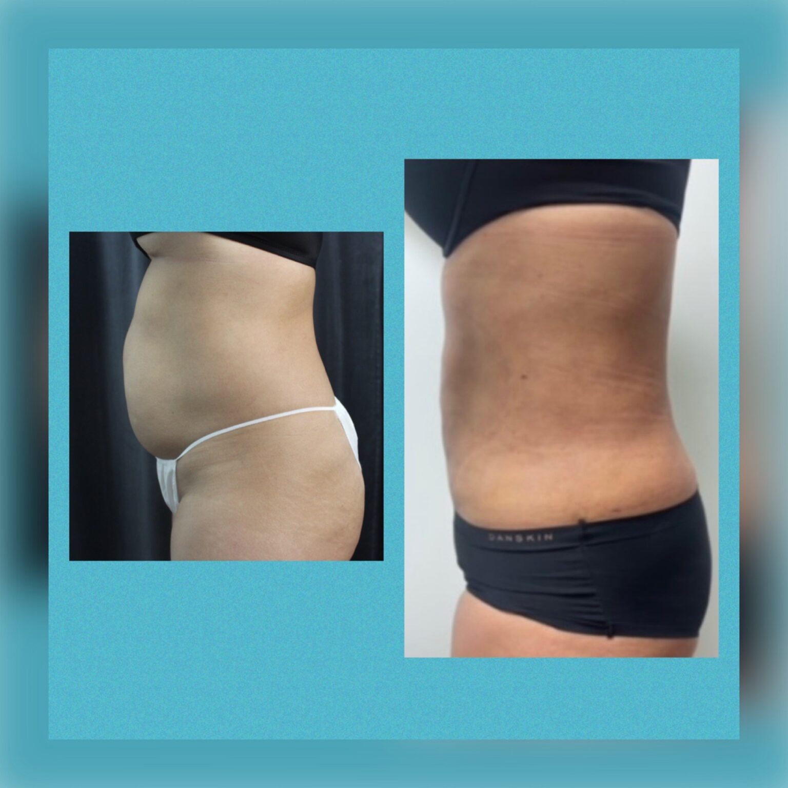 Smart Liposuction Surgery | Houston, TX | Clinic 45