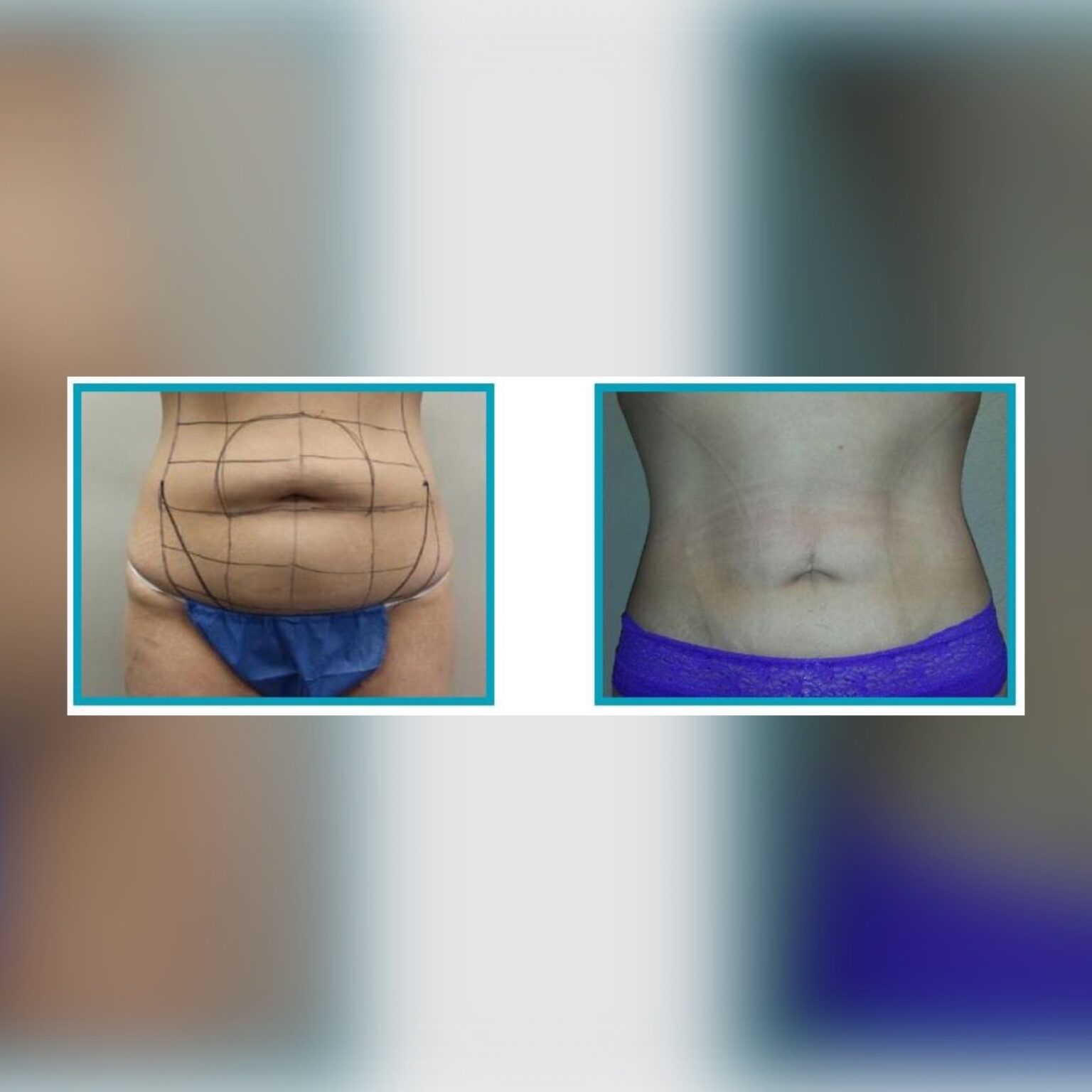 Smart Liposuction Surgery | Houston, TX | Clinic 45