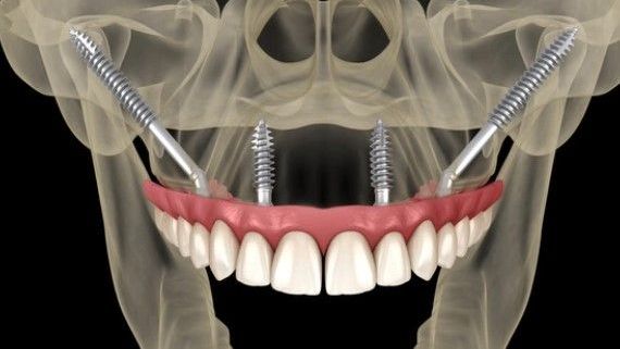 Implante zigomático: saiba o que é e como é feito