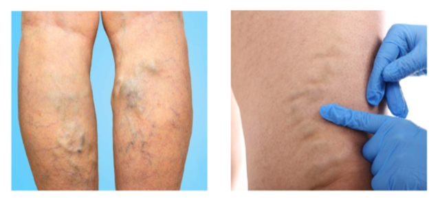 Chronic Venous Insufficiency | Arkansas Vascular & Vein Specialists ...