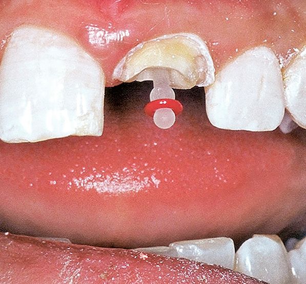 Fiber Posts & Crowns - Deluxe Dentistry