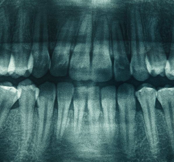 Dental Implants-Internal Sinus Lift Procedure | Deluxe Dentistry