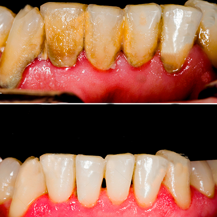 Scaling & Root Planing (Deep Cleaning) - Deluxe Dentistry