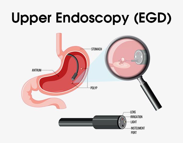 Upper Endoscopy (EGD) | Athens Gastroenterology Center
