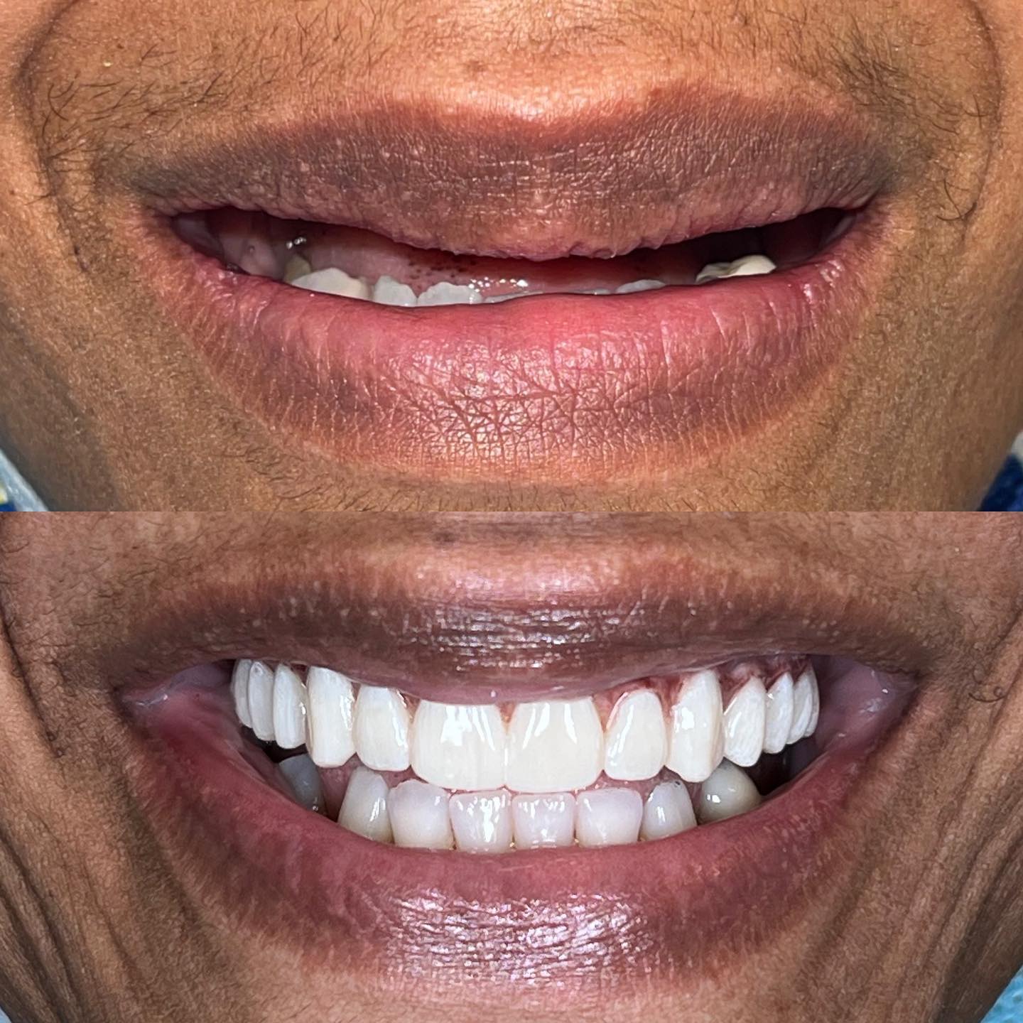 Signature Smiles: Dental Implants Smile Gallery Manchester CT