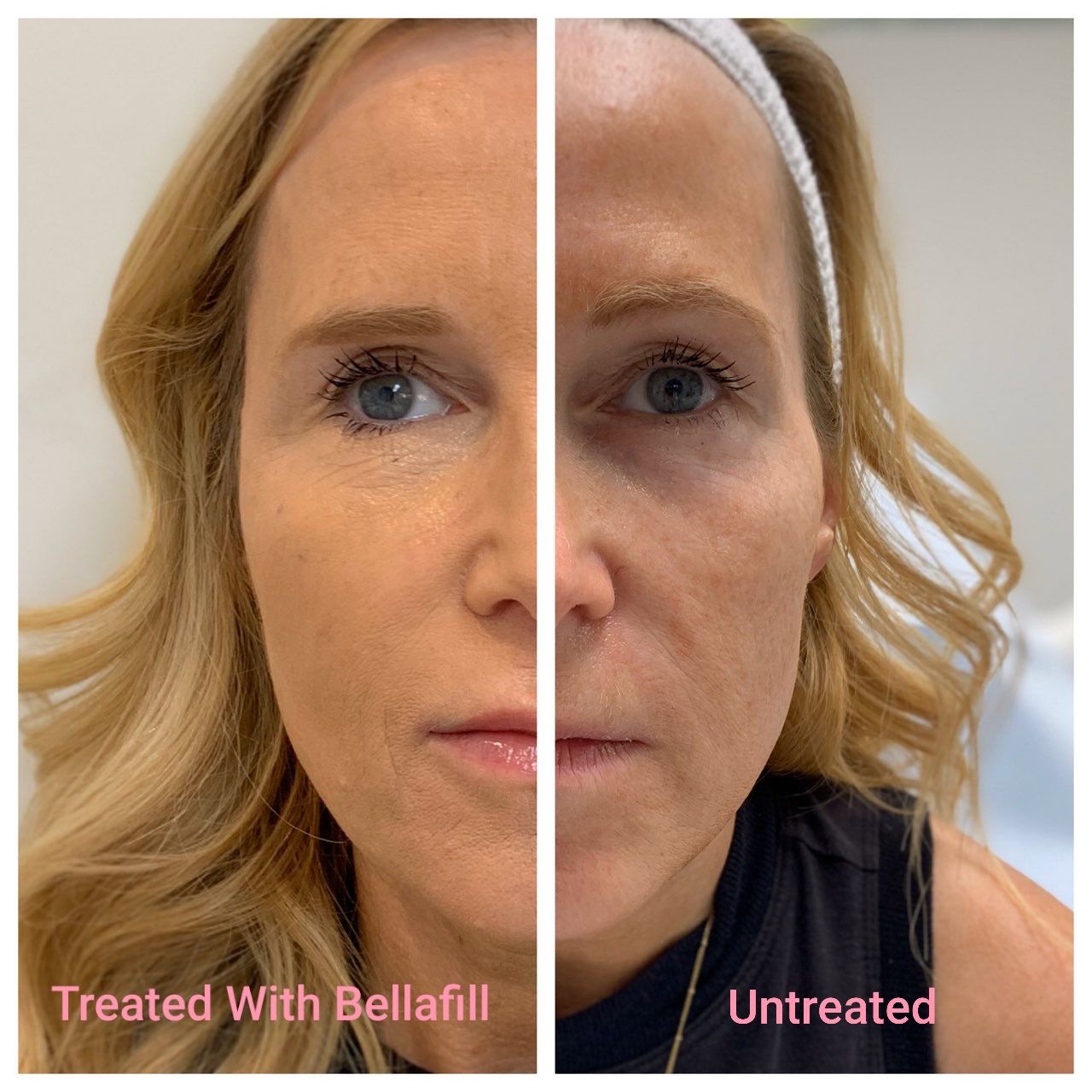 Bellafill - Pure Beauty Med Spa