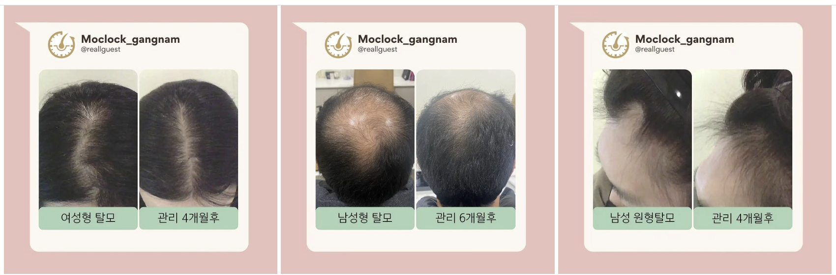 Gangnam Scalp Treatments: Moclock Head Spa Hair Lose Care