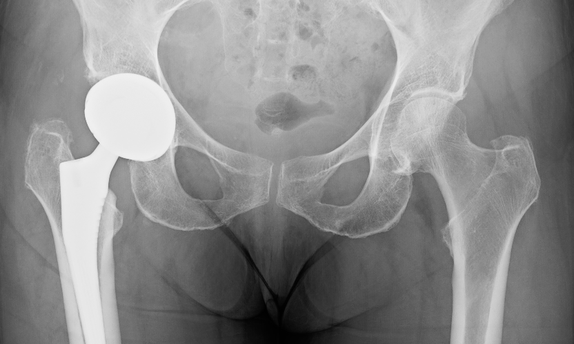 Total Hip Replacement | Hip | Dr Neil Ferguson | Armidale
