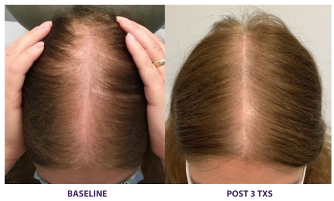 Best TED Hair Restoration Provider on Long Island - Mandel Dermatology