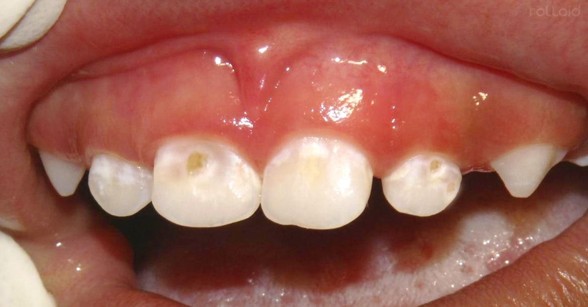 las muleas de mi hijo tienen caries Técnica TRA en Odontología