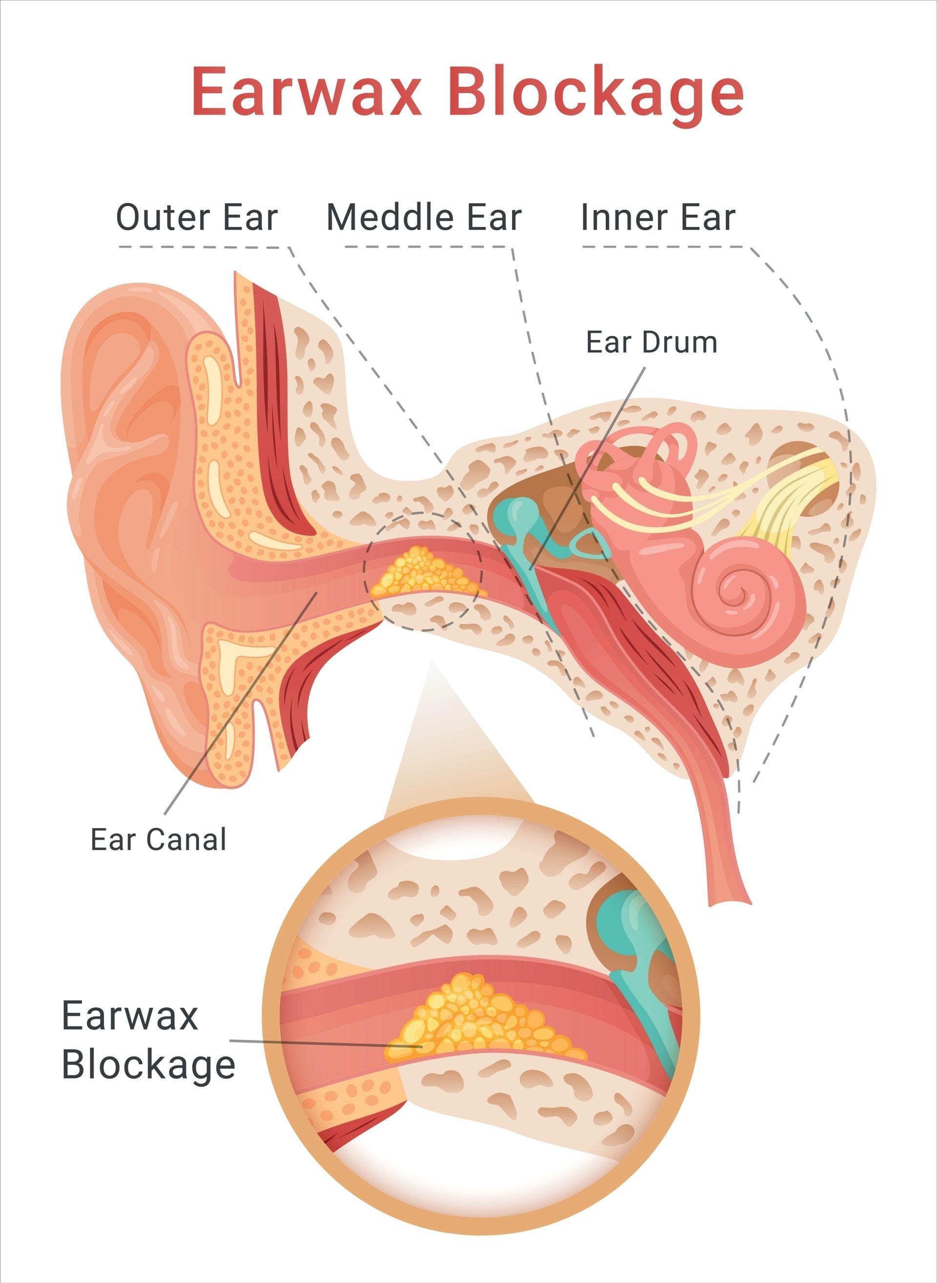 CPT Code 69210: Impacted Earwax Removal Guide