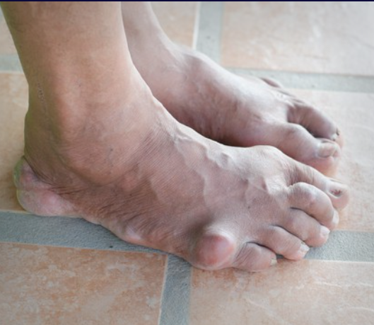 Gout is a common type of arthritis, which causes pain, stiffness, and ...