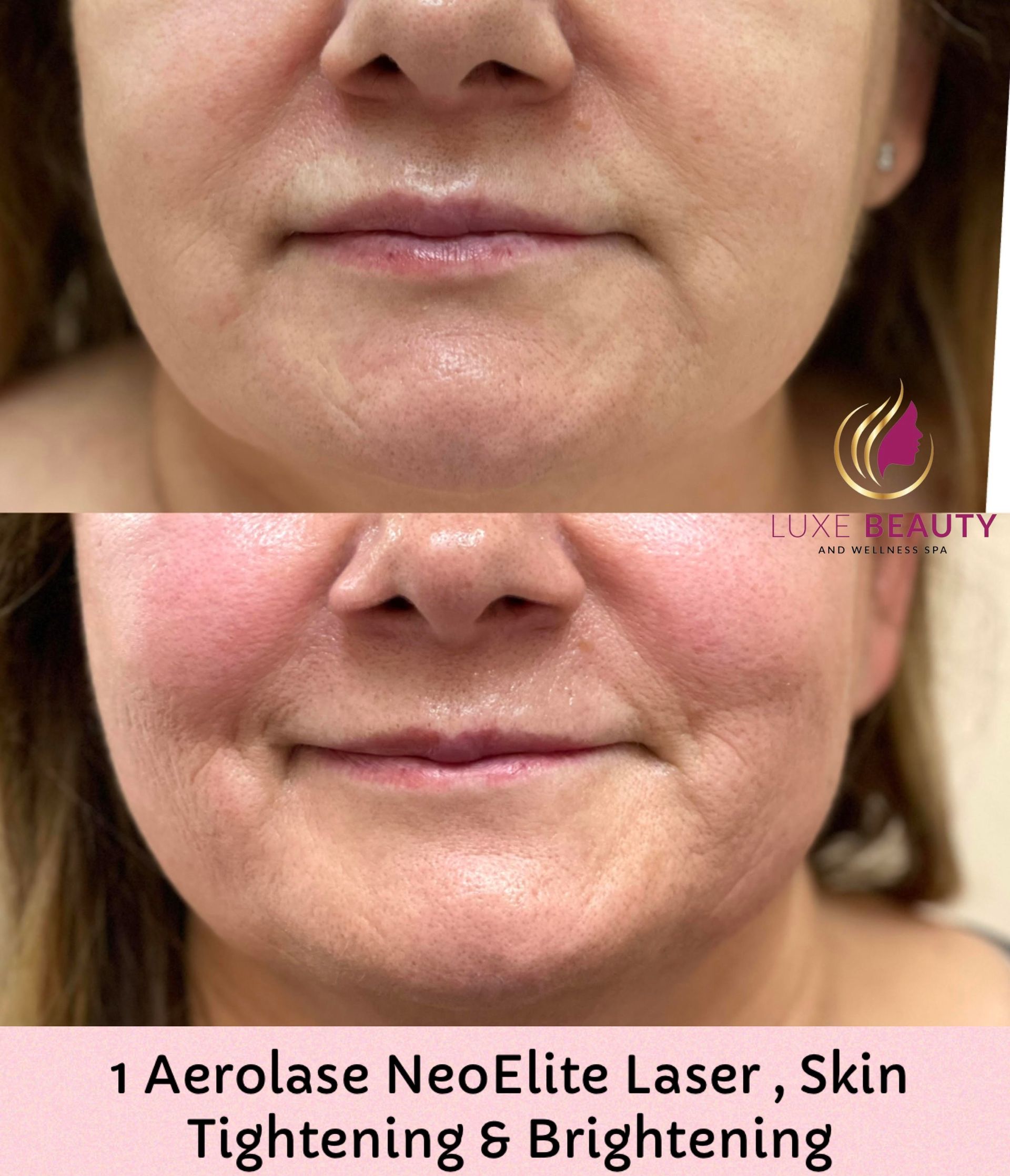 Aerolase Neo Elite Mississauga ON - Luxe Beauty and Wellness Spa