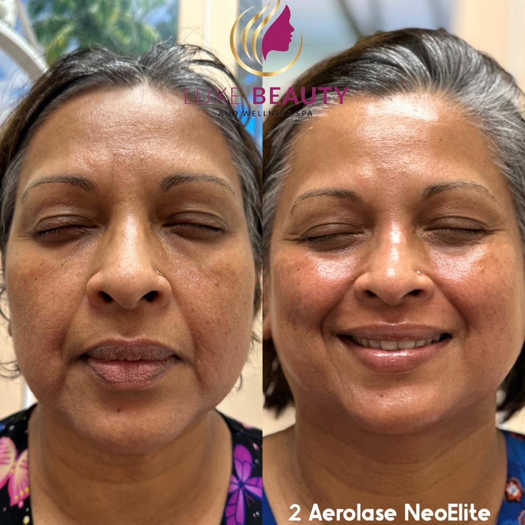 Aerolase Neo Elite Mississauga ON - Luxe Beauty and Wellness Spa