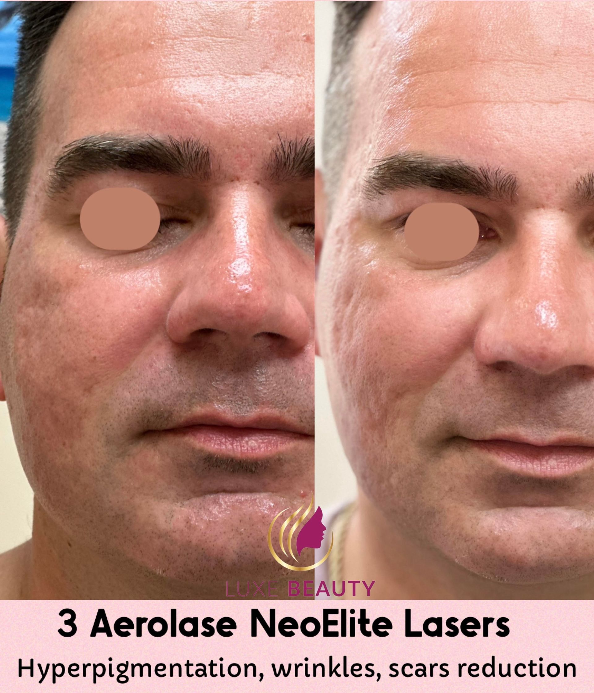 Aerolase Neo Elite Mississauga ON - Luxe Beauty and Wellness Spa