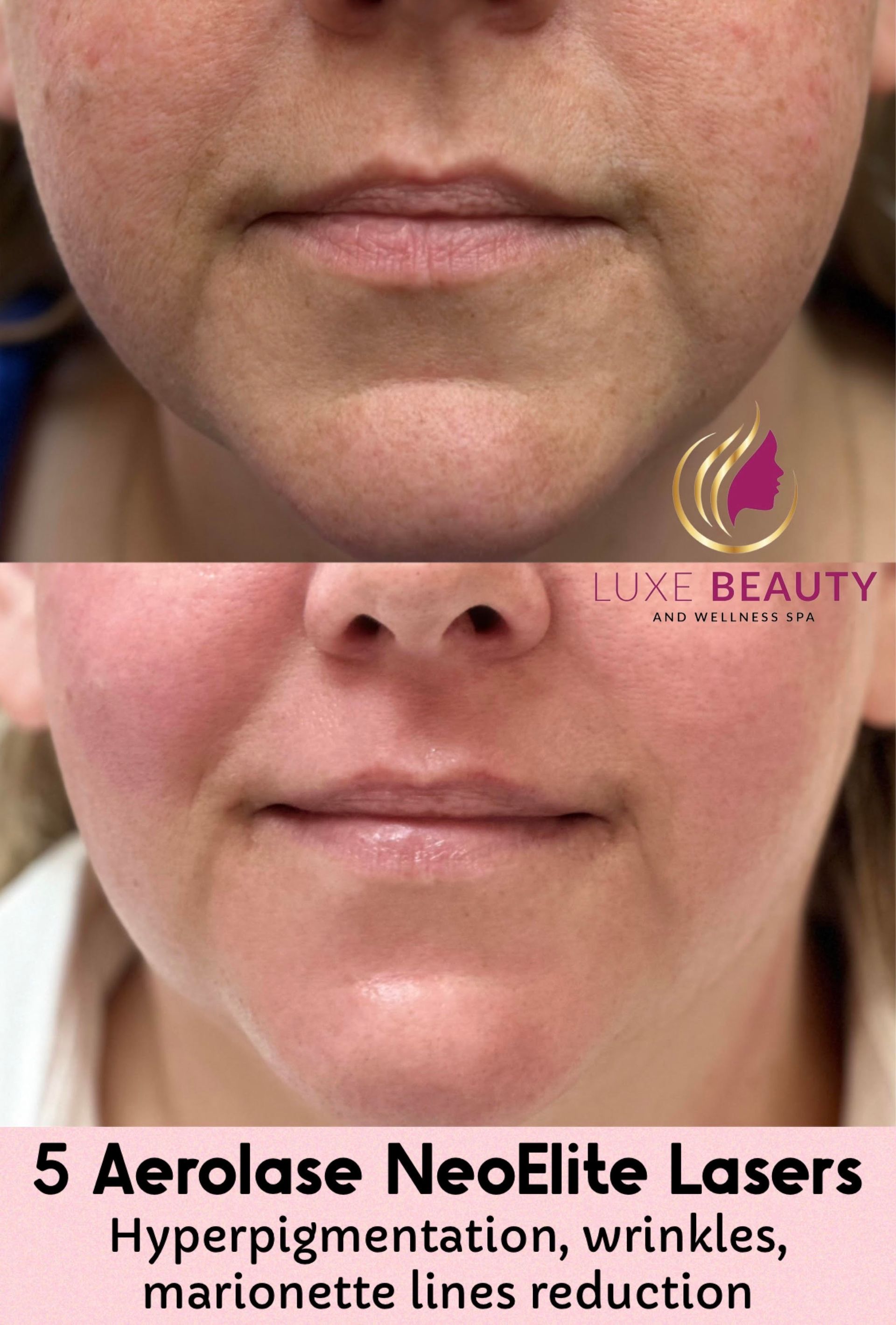 Aerolase Neo Elite Mississauga ON - Luxe Beauty and Wellness Spa