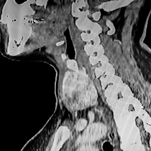 Thyroid Nodule Treatments Nyc Dr John Salerno