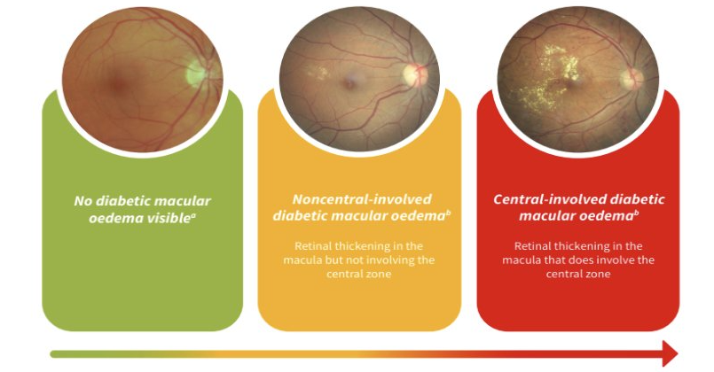 EYES ON DIABETES – DIJABETIČKA RETINOPATIJA