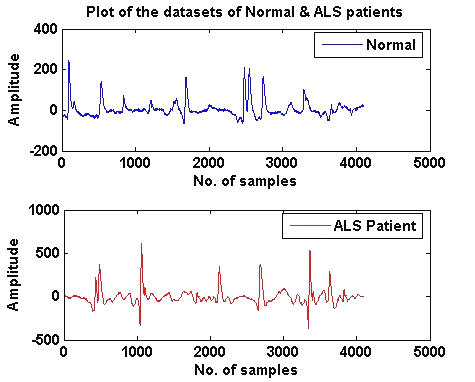 AMIOTROFIČNA LATERALNA SKLEROZA (ALS)