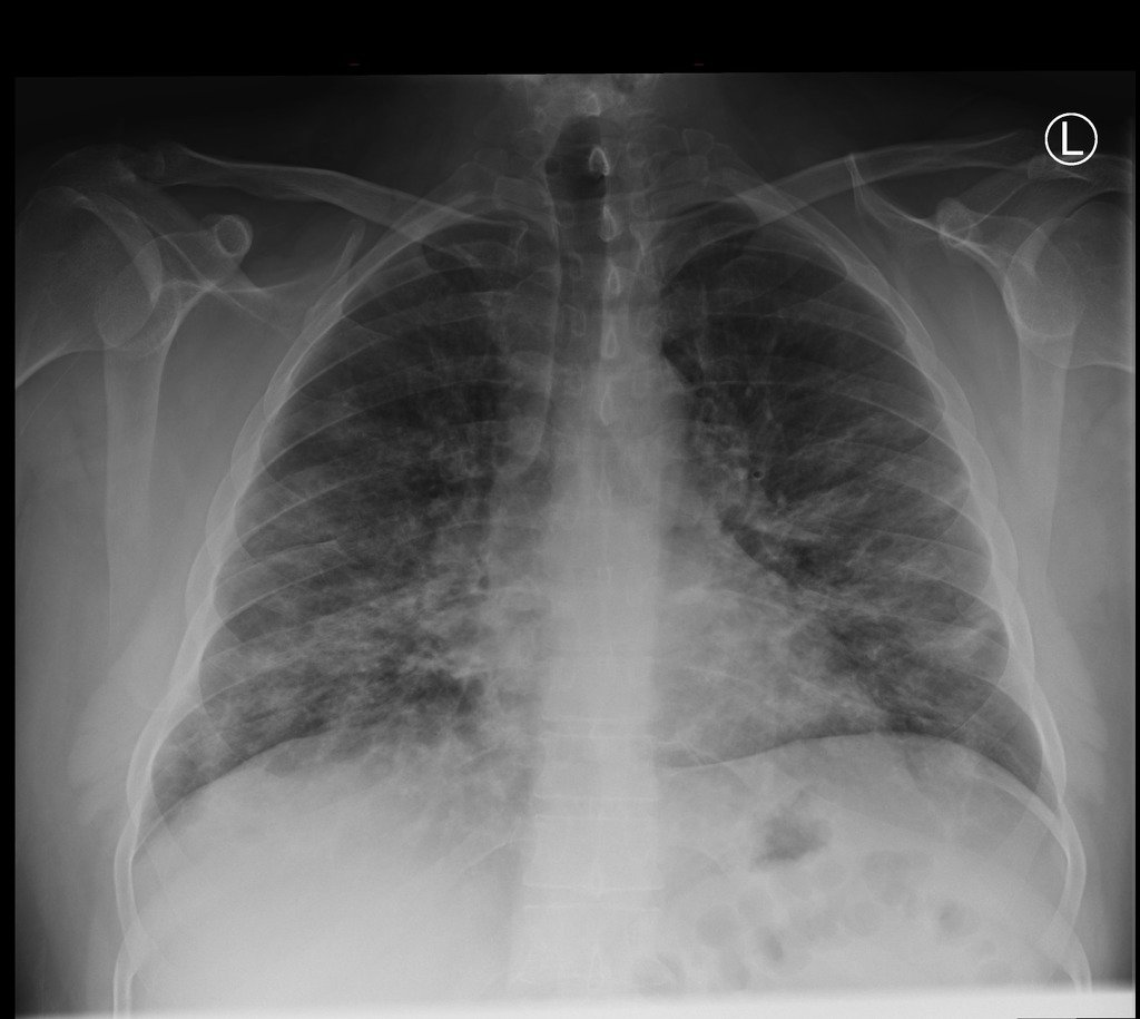 RTG DIJAGNOSTIKA PNEUMONIJA