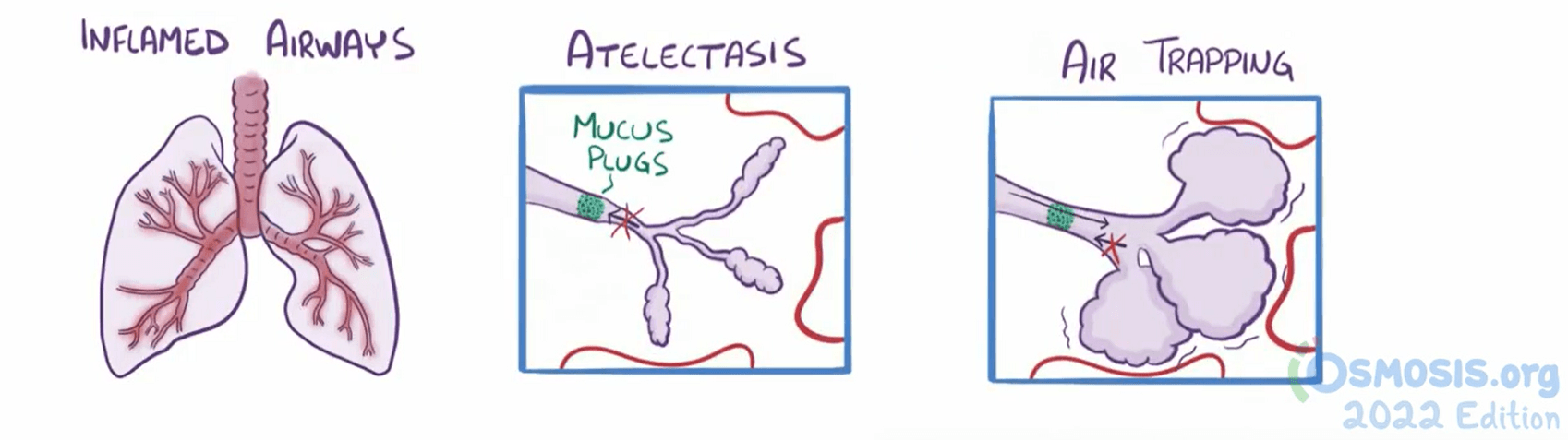 INFEKCIJE RSV-om KOD DJECE