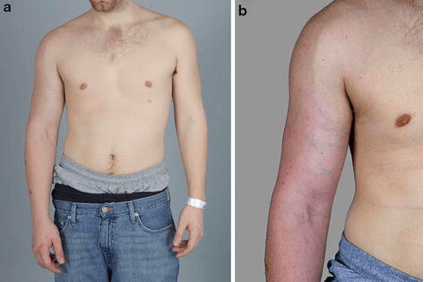 Sindrom gornjeg torakalnog otvora (thoracic outlet syndrome - TOS)