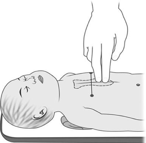 SIDS I REANIMACIJA