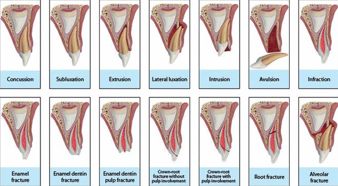 TRAUMATSKE POVREDE I PRVA POMOĆ KOD POVREDE ZUBA