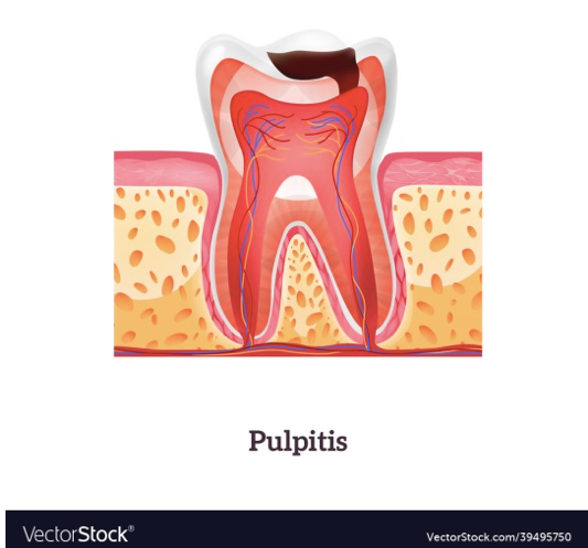 Pulpitis