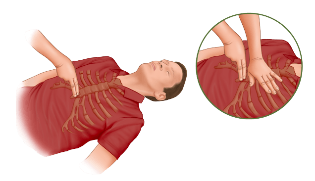 Kardiopulmonalna reanimacija (KPR)– Basic Life Support (BLS)