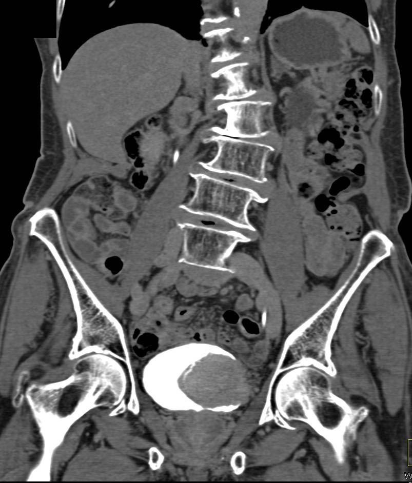 ULOGA CT UROGRAFIJE KOD HEMATURIJE