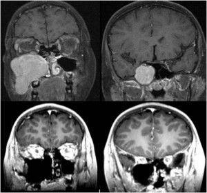 Nasal and Sinus Tumors | Beverly Hills ENT – Los Angeles ENT Specialists