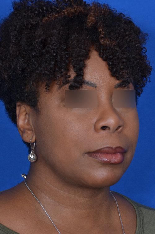 Chin Augmentation Before and After