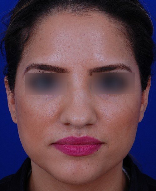 Nostril Reshaping Rhinoplasty Explained