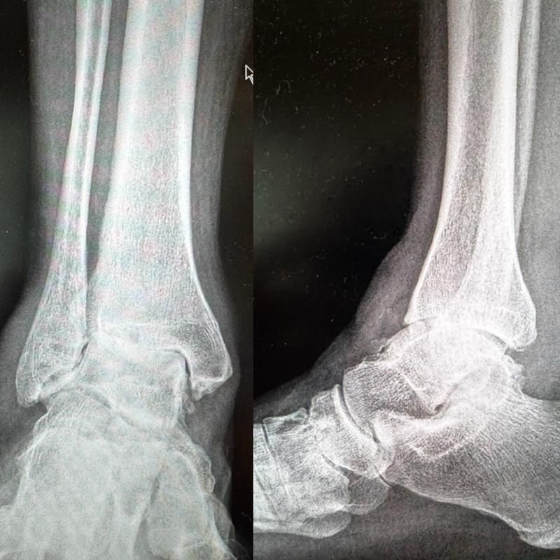 Total Ankle Replacement in Lancaster, CA | Stryker InBone® & Infinity ...