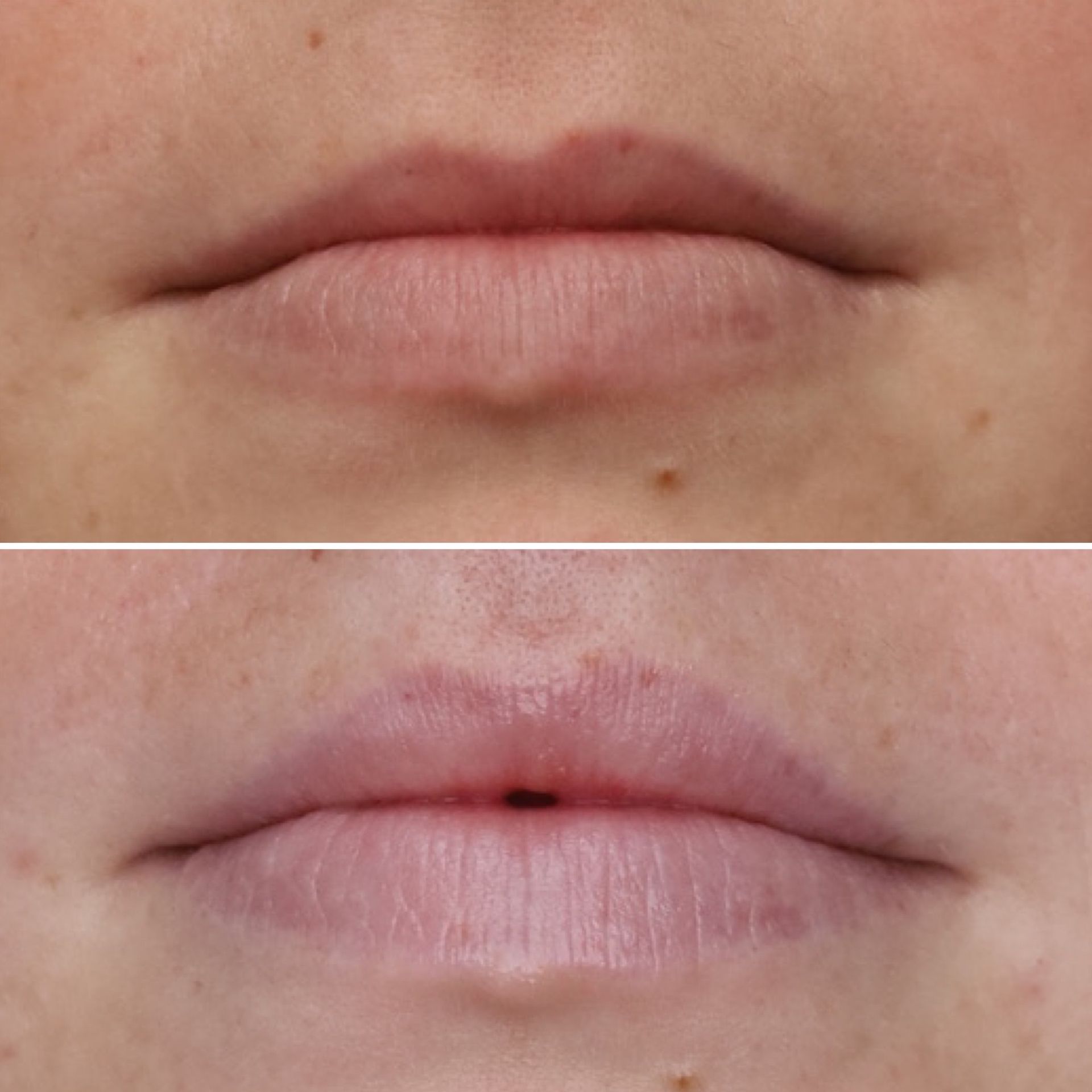 Lip Lift / Modified Upper Lip Lift