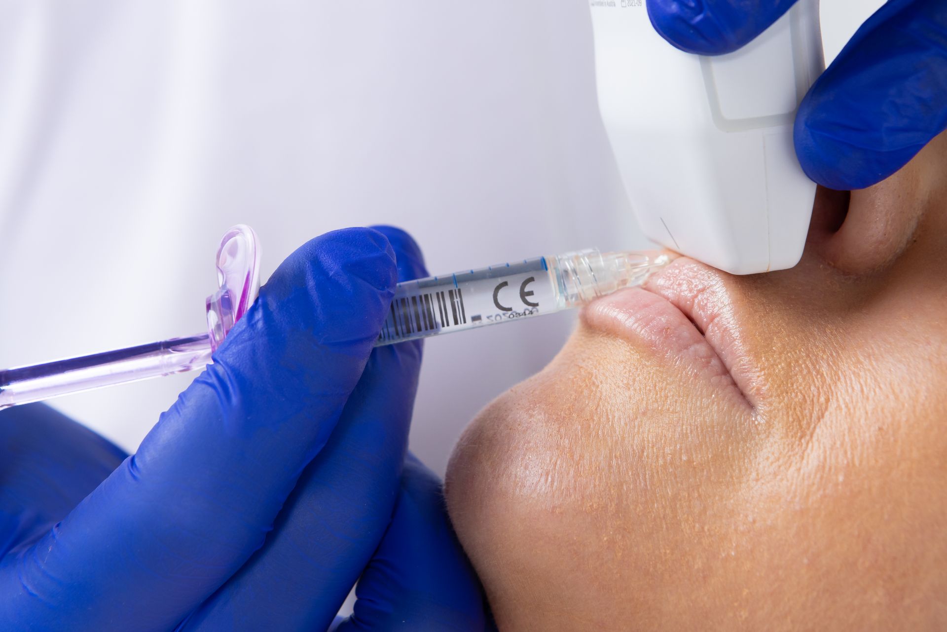 Lip Filler Injections – the new protocol