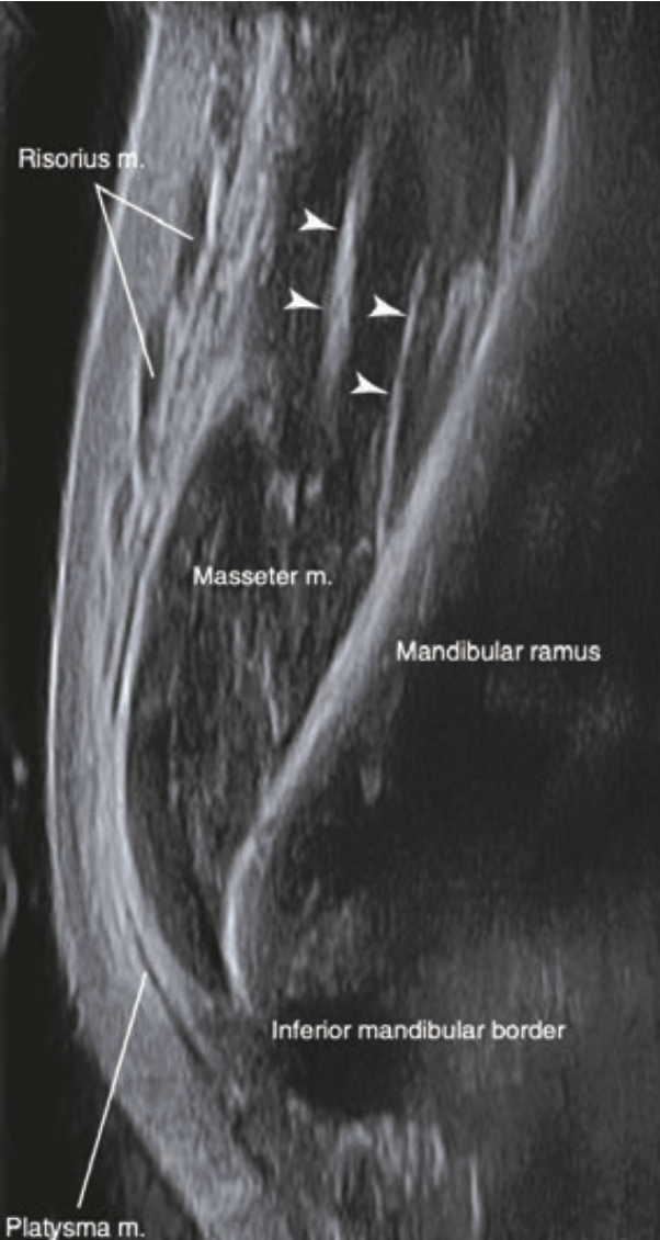 Masseter Muscle Botox injections – the new clinical protocol